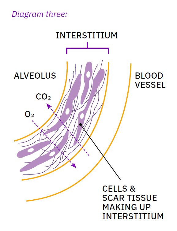 Pulmonary Fibrosis Awareness Month – Lighthouse Group Practice